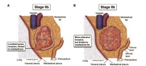 Staging – Foundation for Thymic Cancer Research