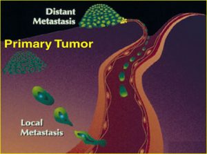 Thymic Carcinoma – Foundation for Thymic Cancer Research