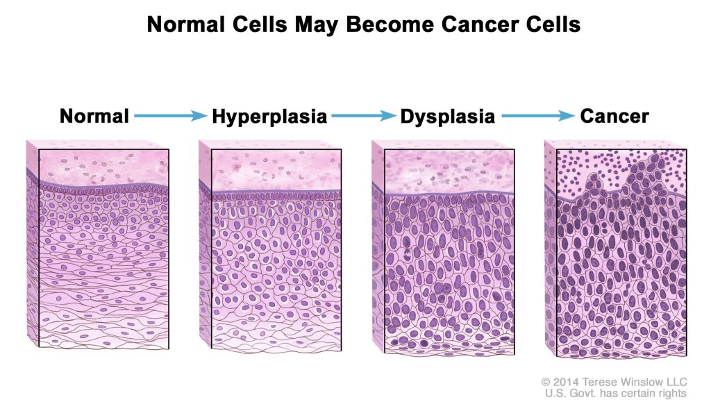 What is Thymic Cancer? – Foundation for Thymic Cancer Research